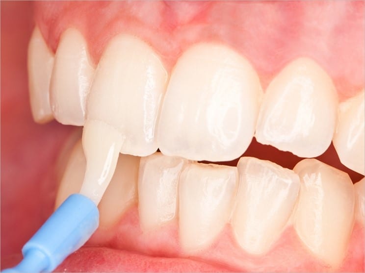 Effective Fluoride Treatment Smiles Holladay UT Dentist